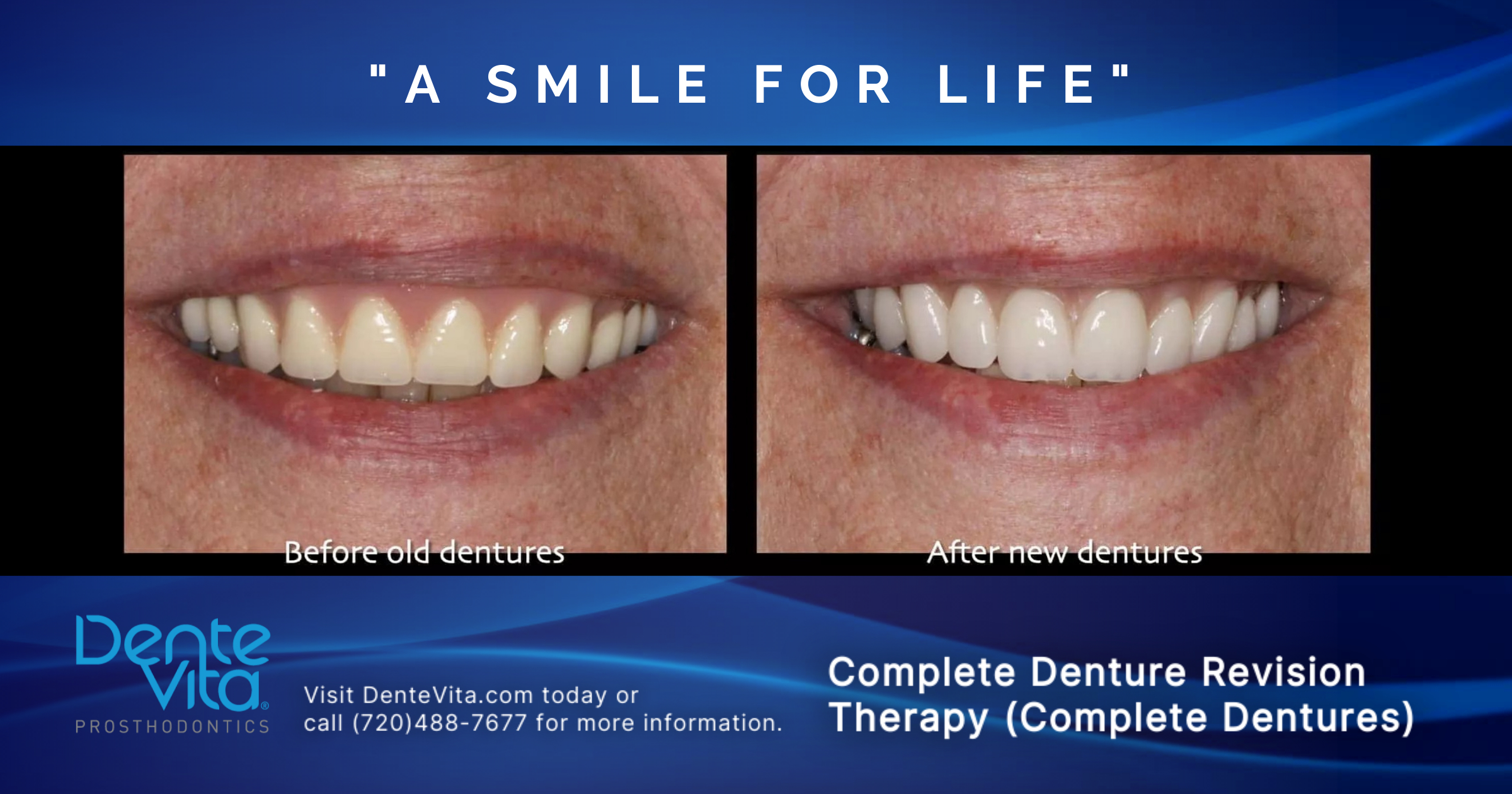 Case Study - Complete Dentures