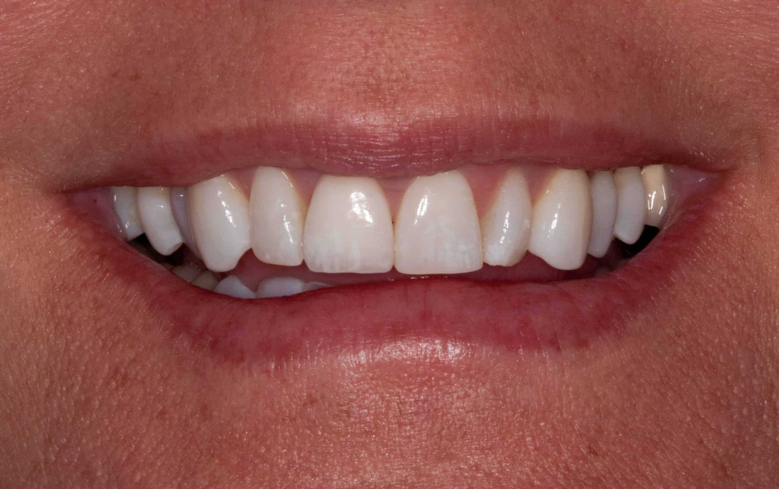 Case Study - Central Incisor