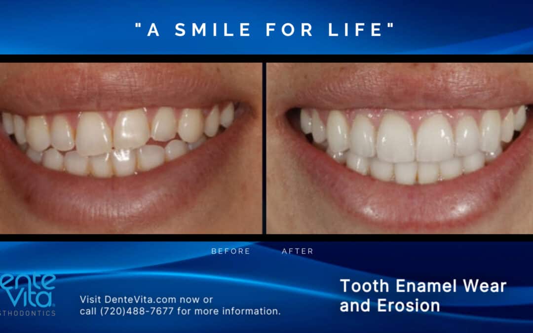 Case Studies – DenteVita Prosthodontics | Aldo Leopardi BDS, DDS, MS